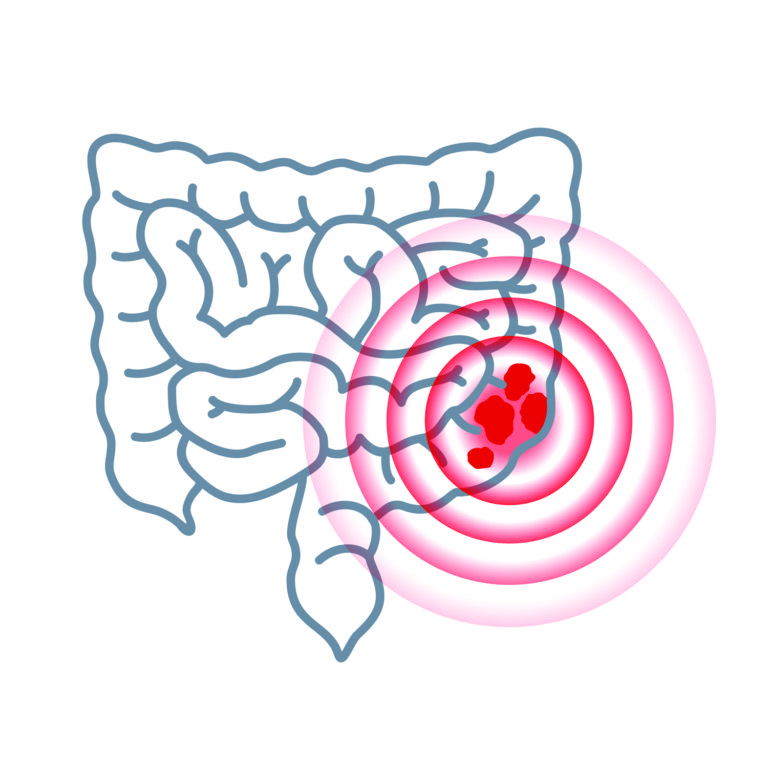 Understanding Polyps & Treatment – Granite State GI NH