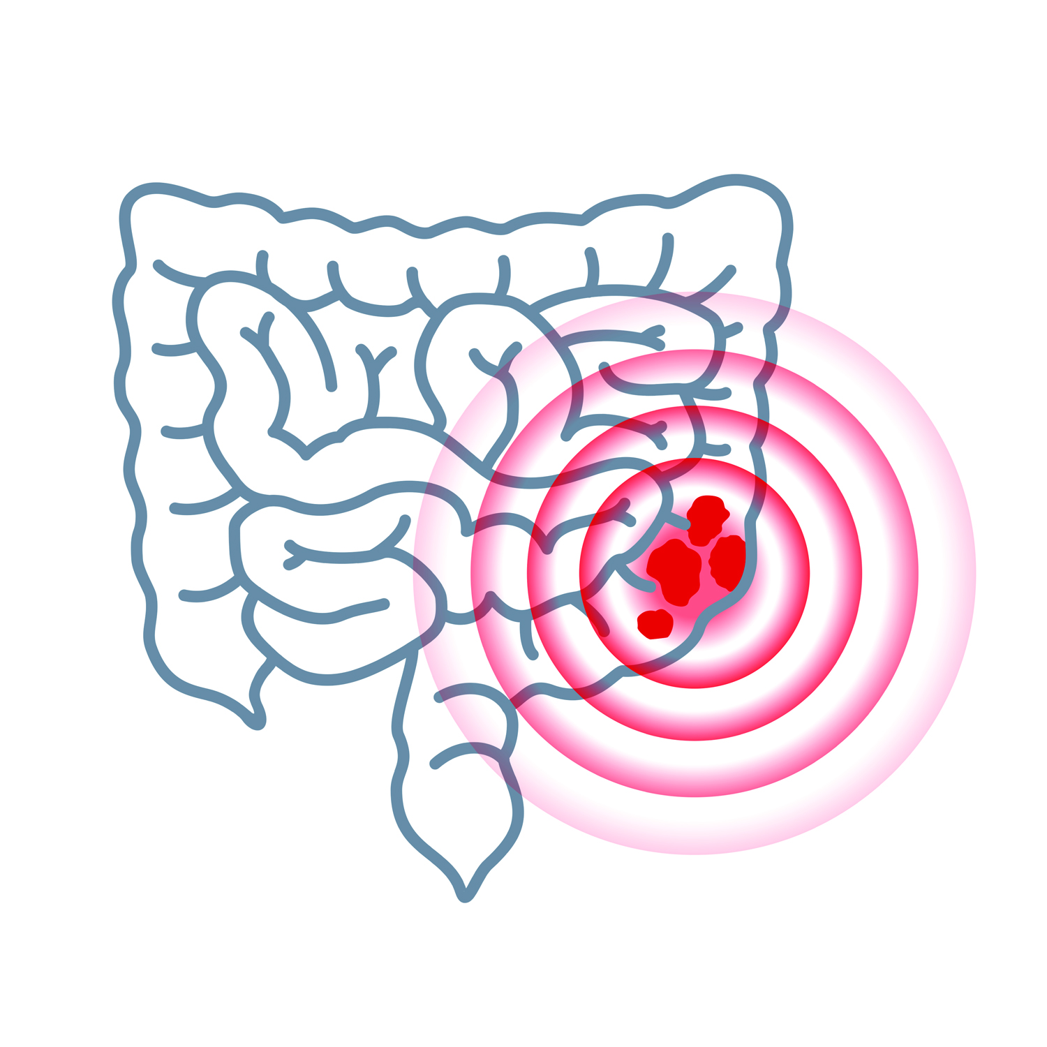 Understanding Colon Polyps | GI Education NH
